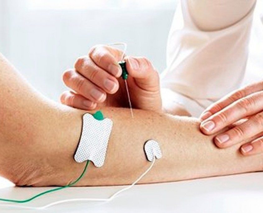 Eletroneuromiografia | Sinapse | Medicina e Saúde